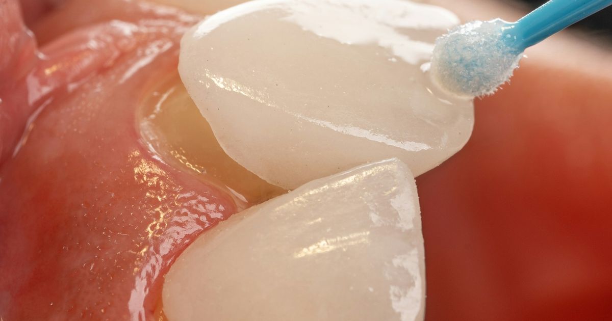 How dental crowns improve your dental health - Swedent | Swedent Dental ...